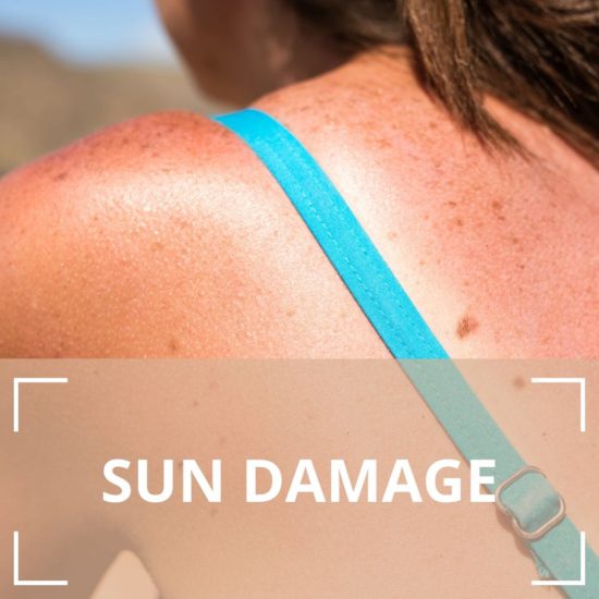 Sun Damage | London Premier Laser Clinic