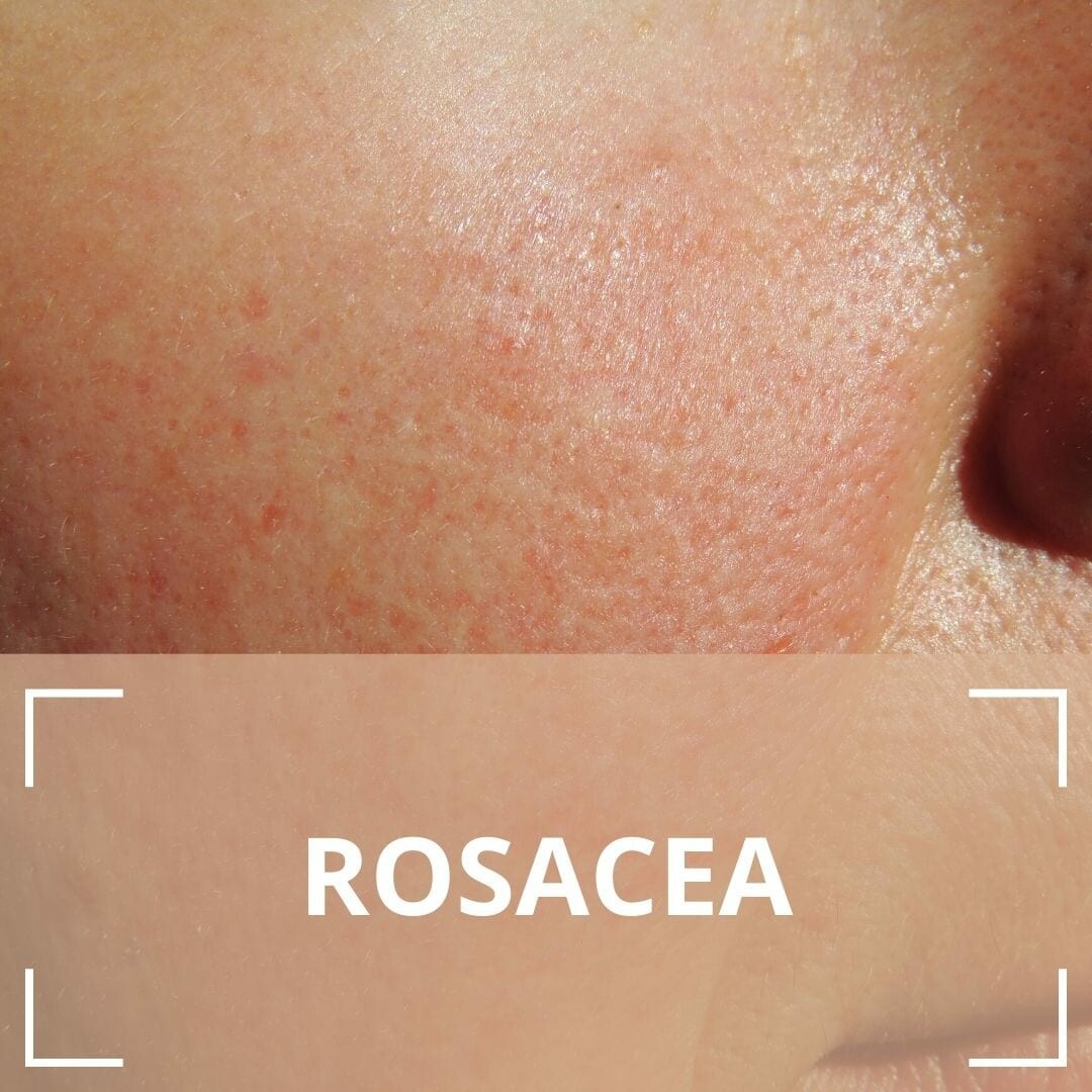 Rosacea (Skin Redness) | London Premier Laser Clinic