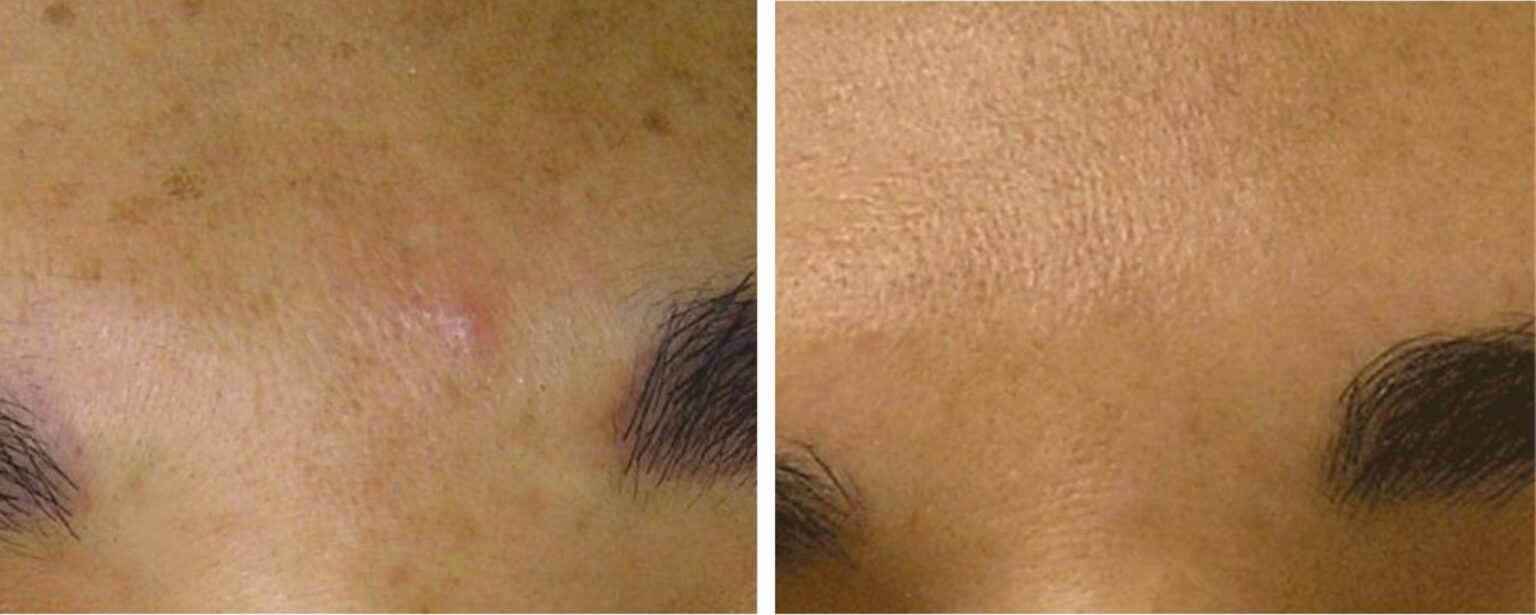 Sun Damage | London Premier Laser Clinic