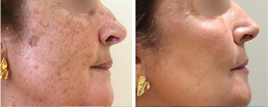 Sun Damage | London Premier Laser Clinic