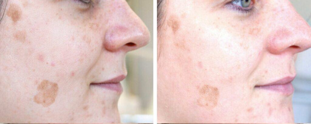 Herbal Green Peel Treatment | London Premier Laser Clinic