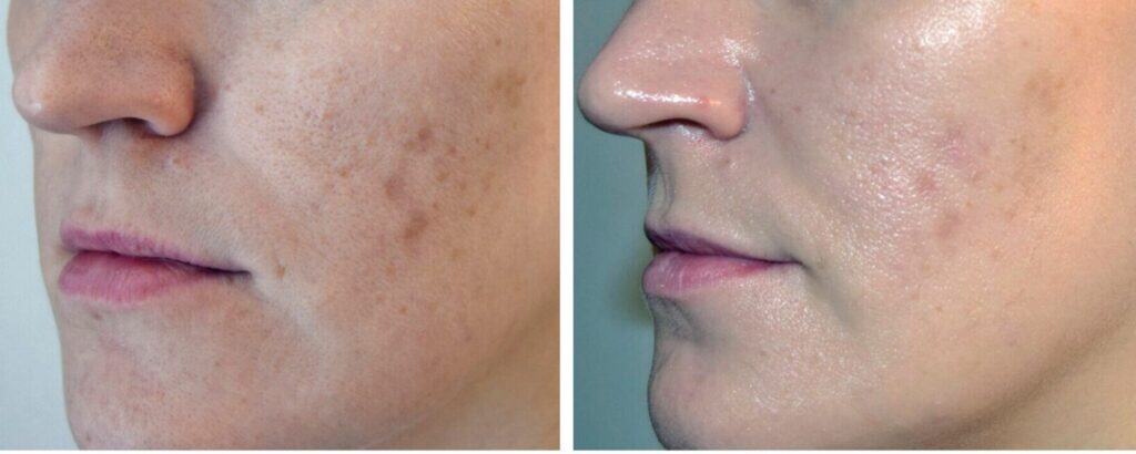Herbal Green Peel Treatment | London Premier Laser Clinic